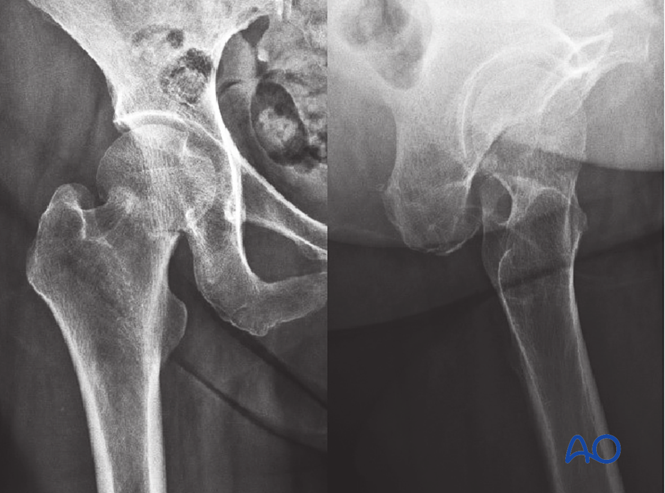 Impacted or nondisplaced subcapital femoral neck fractures