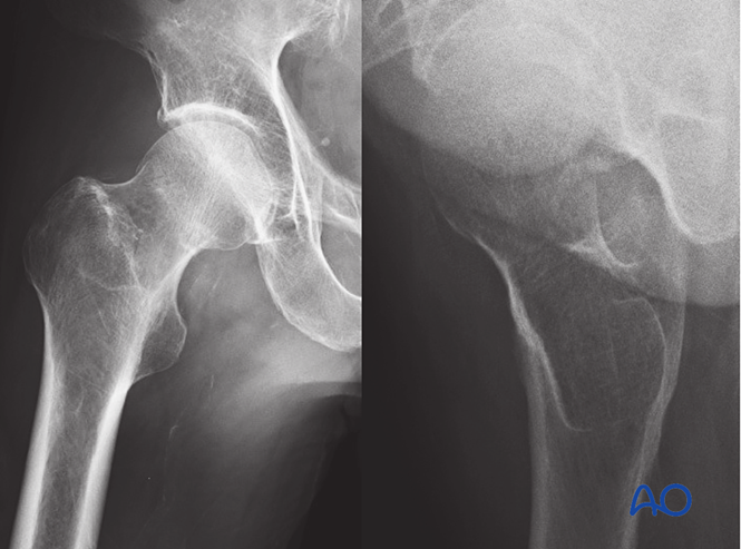 Impacted or nondisplaced subcapital femoral neck fractures