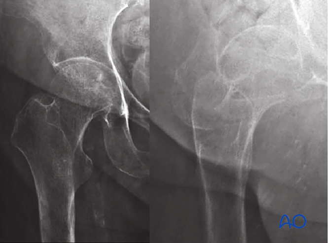 Impacted or nondisplaced subcapital femoral neck fractures