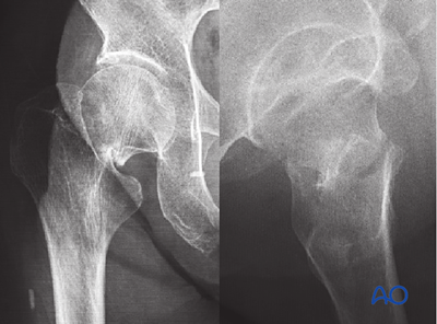 Displaced subcapital femoral neck fractures