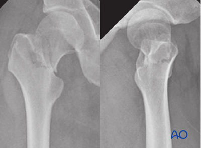 Basicervical femoral neck fractures