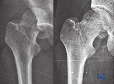Split fractures of the femoral head