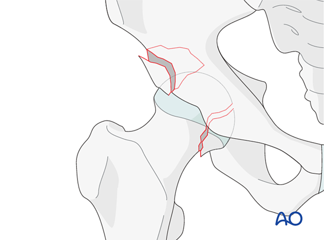 Femoral Head Fractures With Posterior Wall Fracture Of The Acetabulum