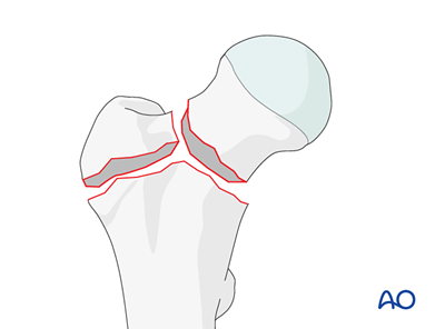Femoral neck and greater trochanter fractures