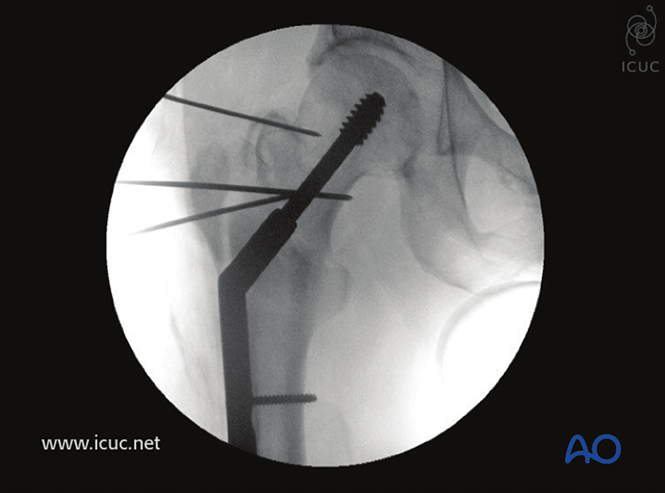 Sliding hip screw with trochanter stabilization plate for ...
