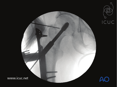 Sliding hip screw with trochanter stabilization plate for ...