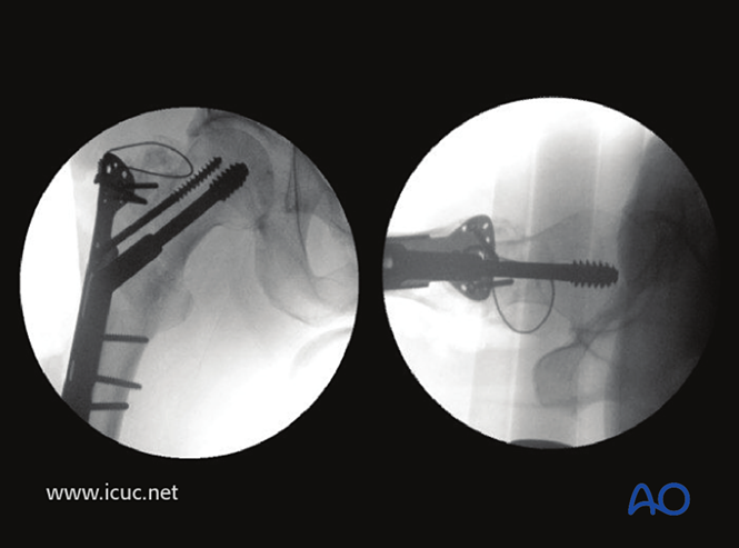 Sliding hip screw with trochanter stabilization plate for ...