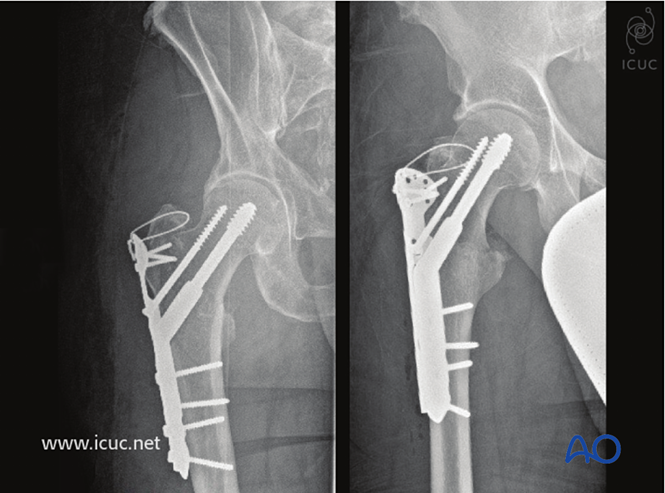Sliding hip screw with trochanter stabilization plate for ...