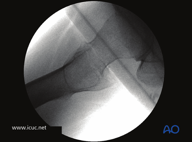 Sliding hip screw for Simple two-part pertrochanteric fractures