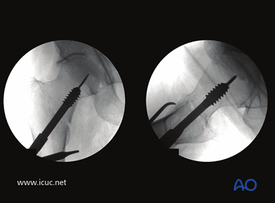 Sliding hip screw for Simple two-part pertrochanteric fractures