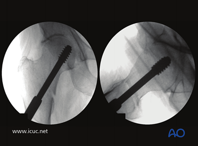 Sliding hip screw for Simple two-part pertrochanteric fractures