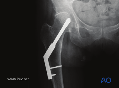 Sliding hip screw for Simple two-part pertrochanteric fractures