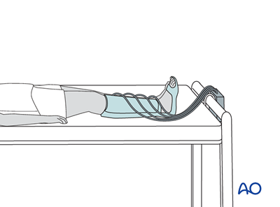 Nonoperative treatment for Isolated single trochanter fractures