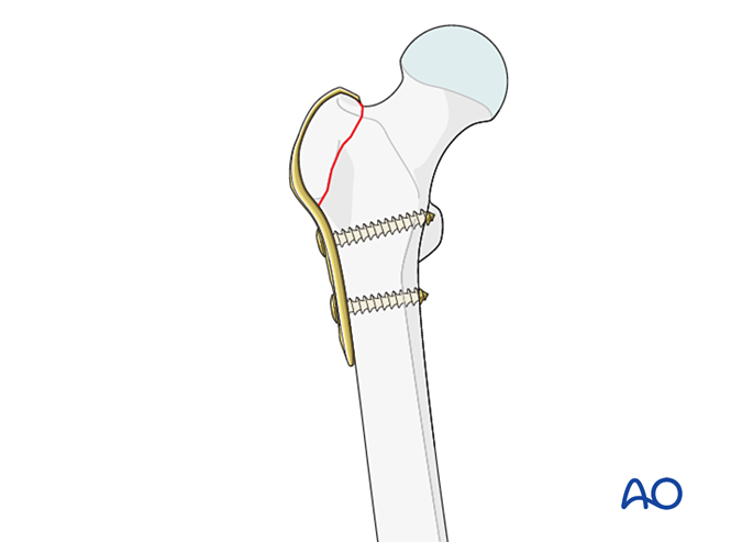 Hook plate fixation for Isolated single trochanter fractures