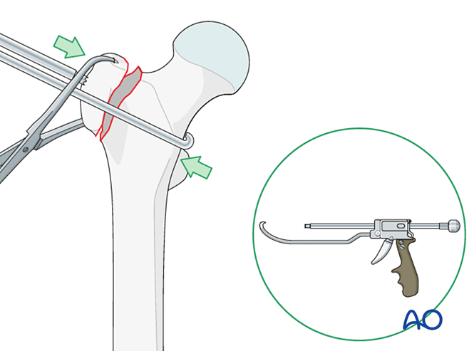 Tension band wiring for Isolated single trochanter fractures