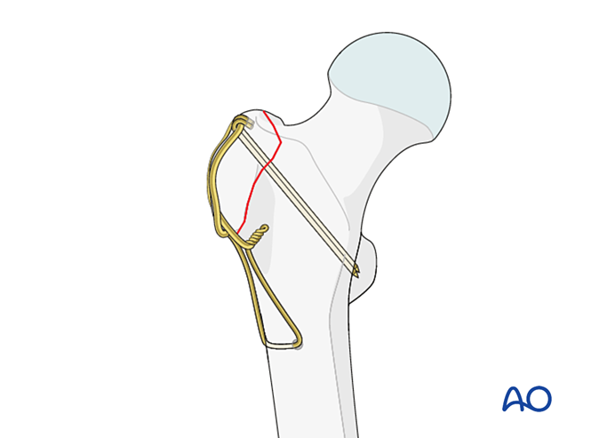 Tension band wiring for Isolated single trochanter fractures