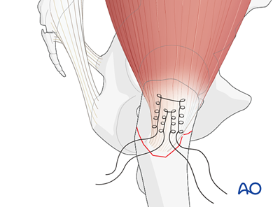 Tension band wiring for Isolated single trochanter fractures