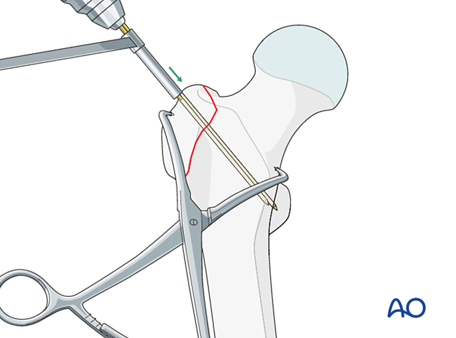 Tension band wiring for Isolated single trochanter fractures