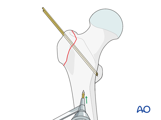 Tension band wiring for Isolated single trochanter fractures