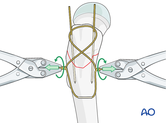 Tension band wiring for Isolated single trochanter fractures