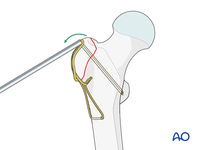 Tension band wiring for Isolated single trochanter fractures