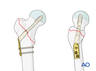 Sliding hip screw for Simple two-part pertrochanteric fractures
