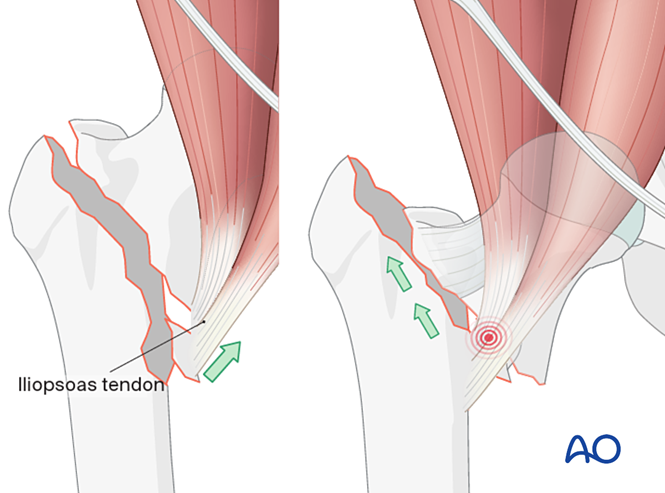 Sliding hip screw for Simple pertrochanteric fractures with ...