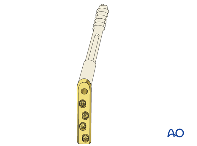 Sliding hip screw with trochanter stabilization plate for ...