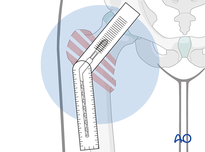 Sliding hip screw for Simple two-part pertrochanteric fractures