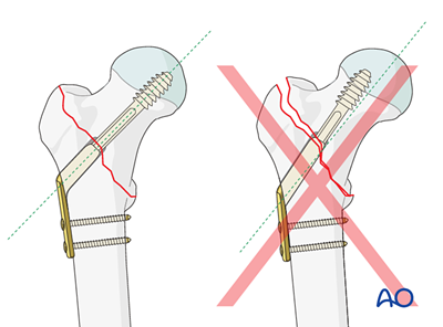 Sliding hip screw for Simple two-part pertrochanteric fractures