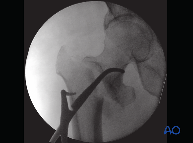 Sliding hip screw for Simple two-part pertrochanteric fractures