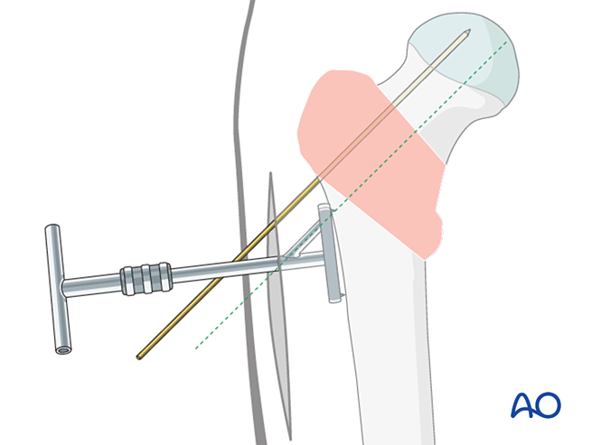 Sliding hip screw for Simple two-part pertrochanteric fractures