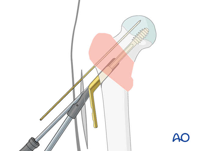 Sliding hip screw for Simple two-part pertrochanteric fractures