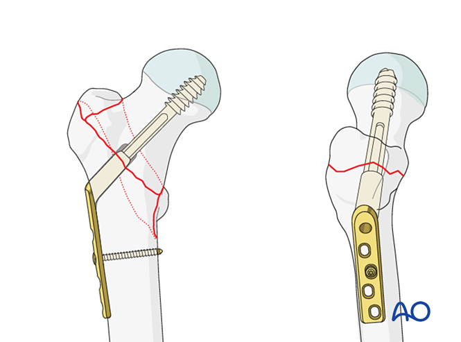 Sliding hip screw with trochanter stabilization plate for ...