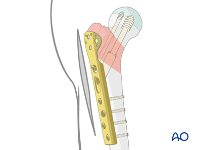 Sliding hip screw with trochanter stabilization plate for ...