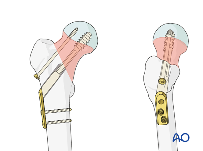 Sliding hip screw with antirotation screw for Basicervical femoral neck ...