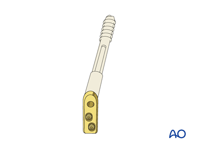 Sliding hip screw with antirotation screw for Basicervical femoral neck ...
