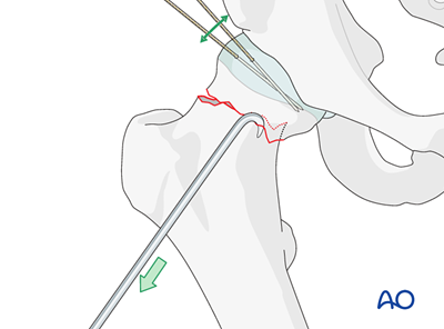 Femoral neck system for Transcervical femoral neck fractures (simple or ...