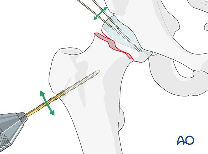Femoral neck system for Displaced subcapital femoral neck fractures