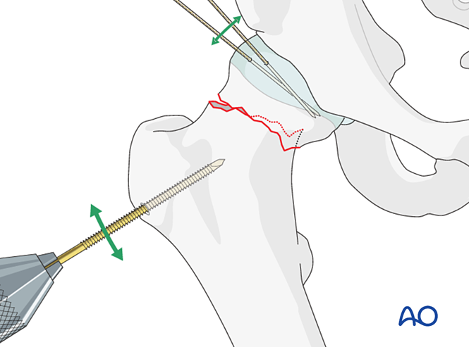 Femoral neck system for Transcervical femoral neck fractures (simple or ...