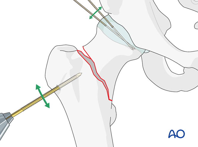 Femoral neck system for Basicervical femoral neck fractures