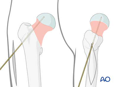 Sliding hip screw with antirotation screw for Basicervical femoral neck ...
