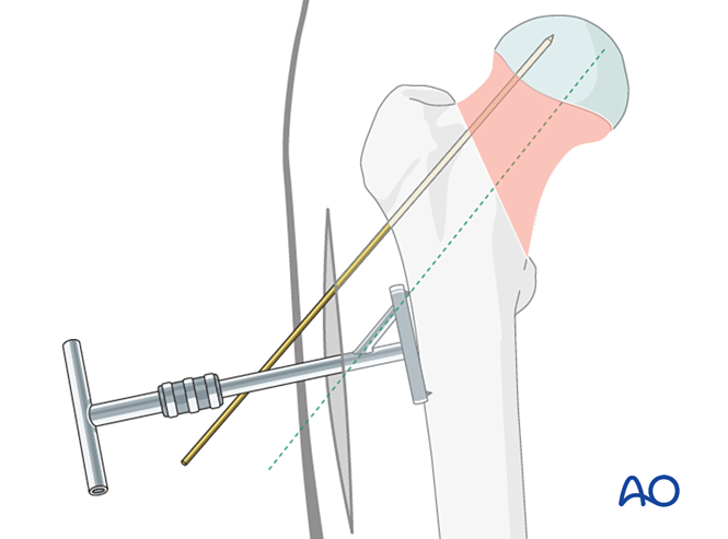 Sliding hip screw with antirotation screw for Basicervical femoral neck ...