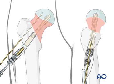 Sliding hip screw with antirotation screw for Basicervical femoral neck ...
