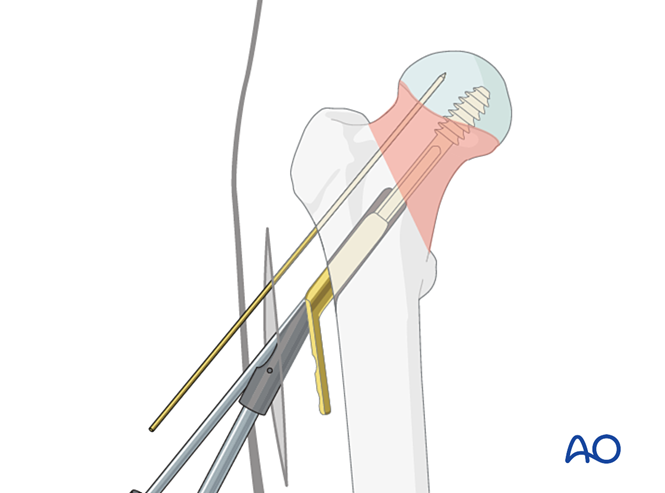 Sliding hip screw with antirotation screw for Basicervical femoral neck ...