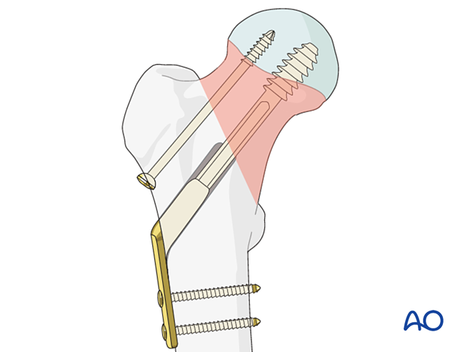 Sliding hip screw with antirotation screw for Basicervical femoral neck ...
