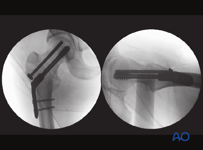Sliding hip screw with antirotation screw for Basicervical femoral neck ...