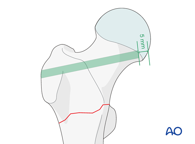 Angled blade plate for Intertrochanteric fractures