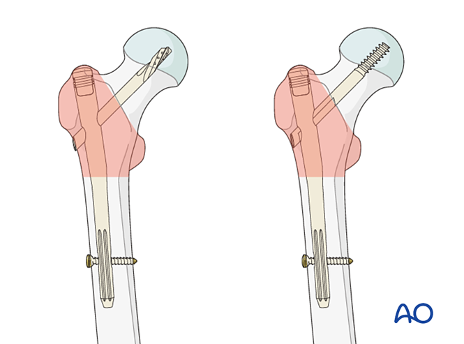 Nailing for Simple pertrochanteric fractures with posteromedial involvement