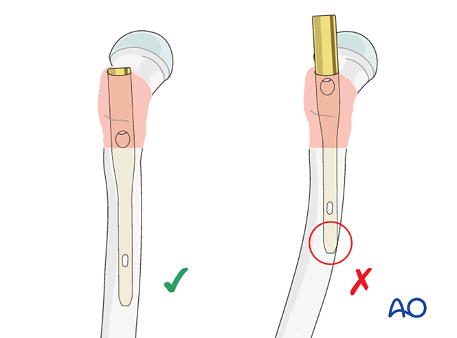 Nailing (short nail) for Intertrochanteric fractures